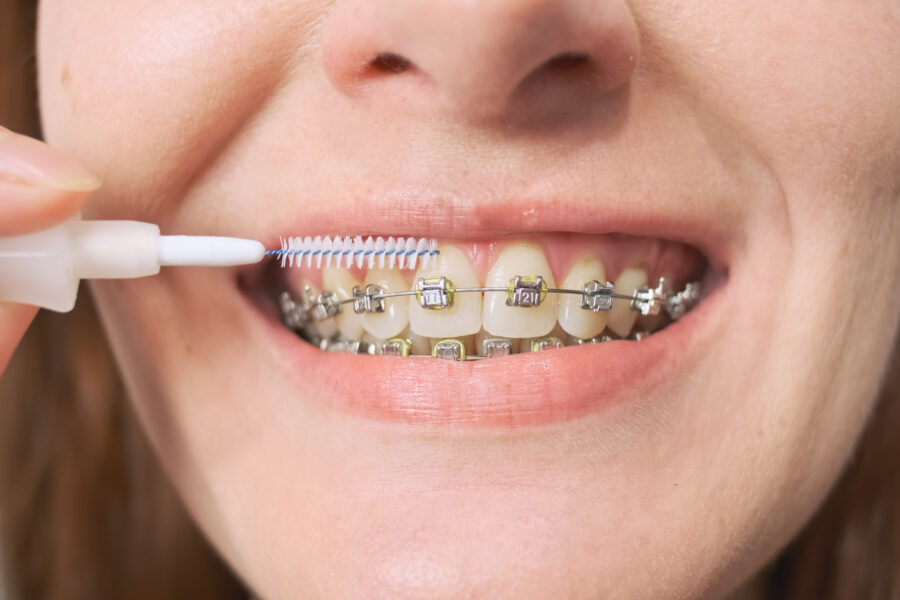 How to Care for Your Braces: Top Tips for Maintenance - Reuland ...